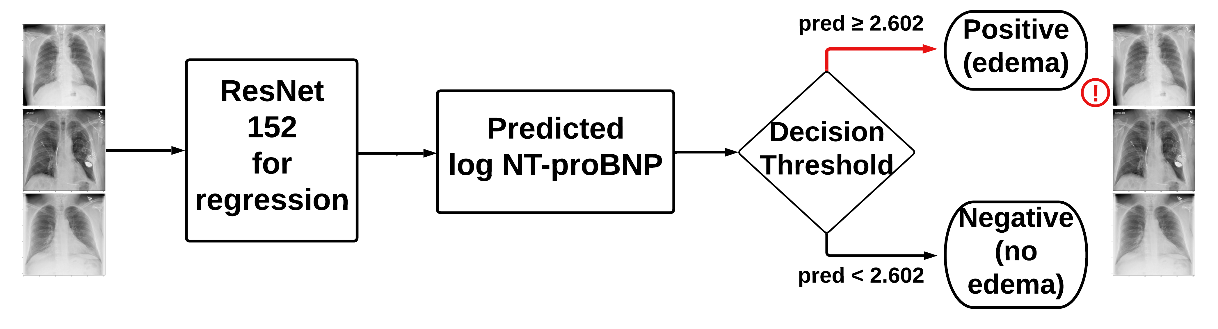 Predicting Pulmonary Edema Using Deep Learning and Image Segmentation