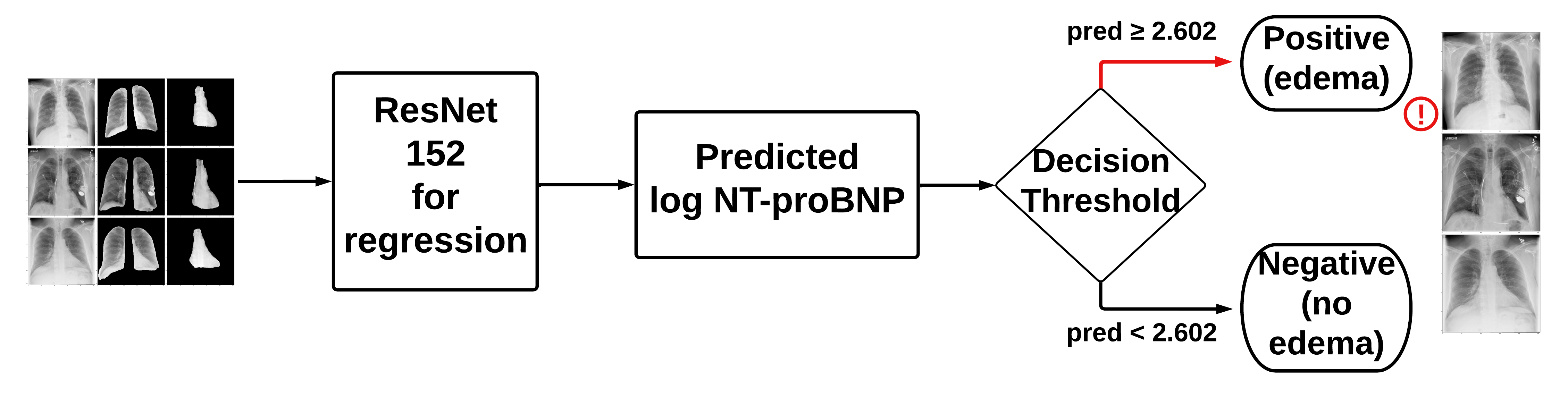 Predicting Pulmonary Edema Using Deep Learning and Image Segmentation